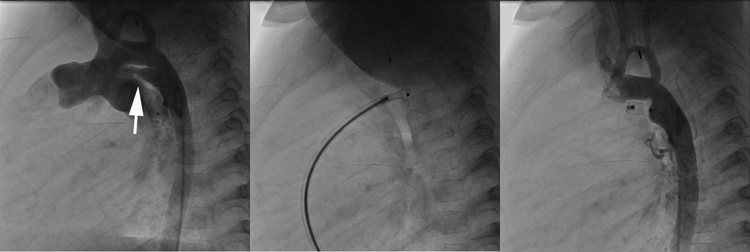 Pediatric Cardiac Catheterization Program | Patient Care